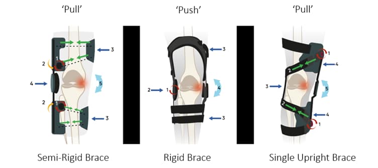 The role of knee bracing in the management of osteoarthritis knee pain ...